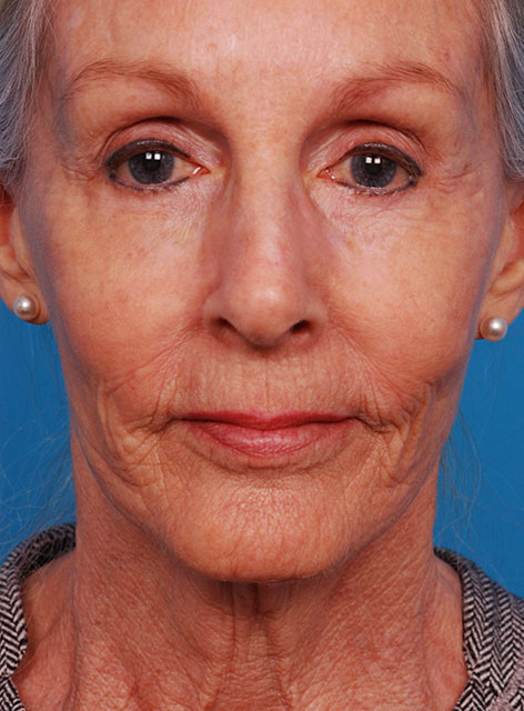 Newport Beach Skin Resurfacing Before and After Photos - Patient 14999 ...