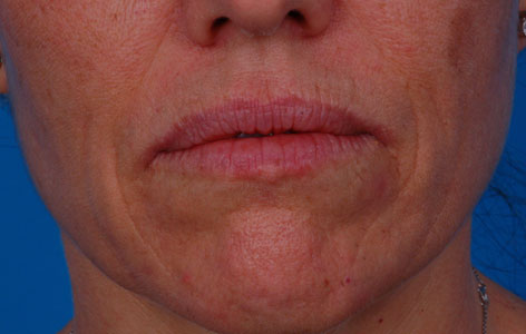 Newport Beach Skin Resurfacing Before and After Photos - Patient 15031 ...